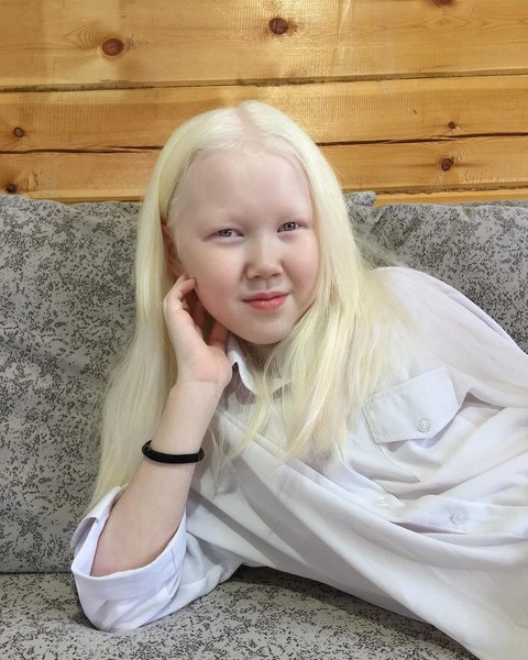 What does the albino girl Naryana look like today